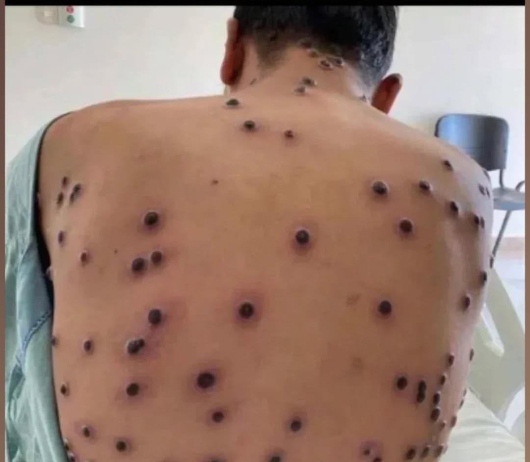 Understanding Monkeypox: Key Guidelines for Managing the Viral Disease - Everything