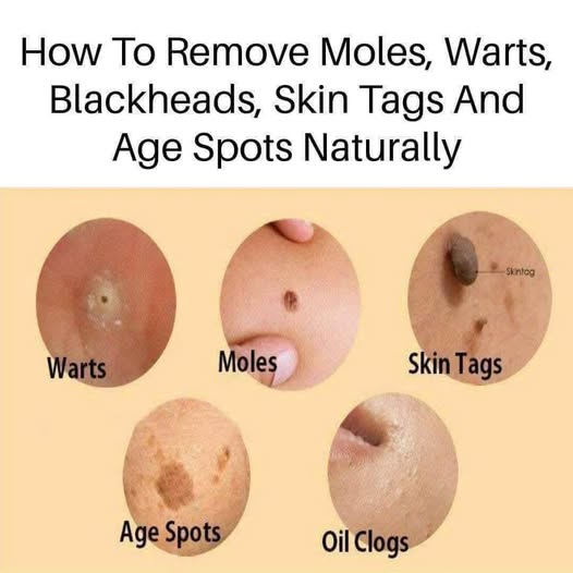 Natural remedies for treating age spots, moles, - Everything