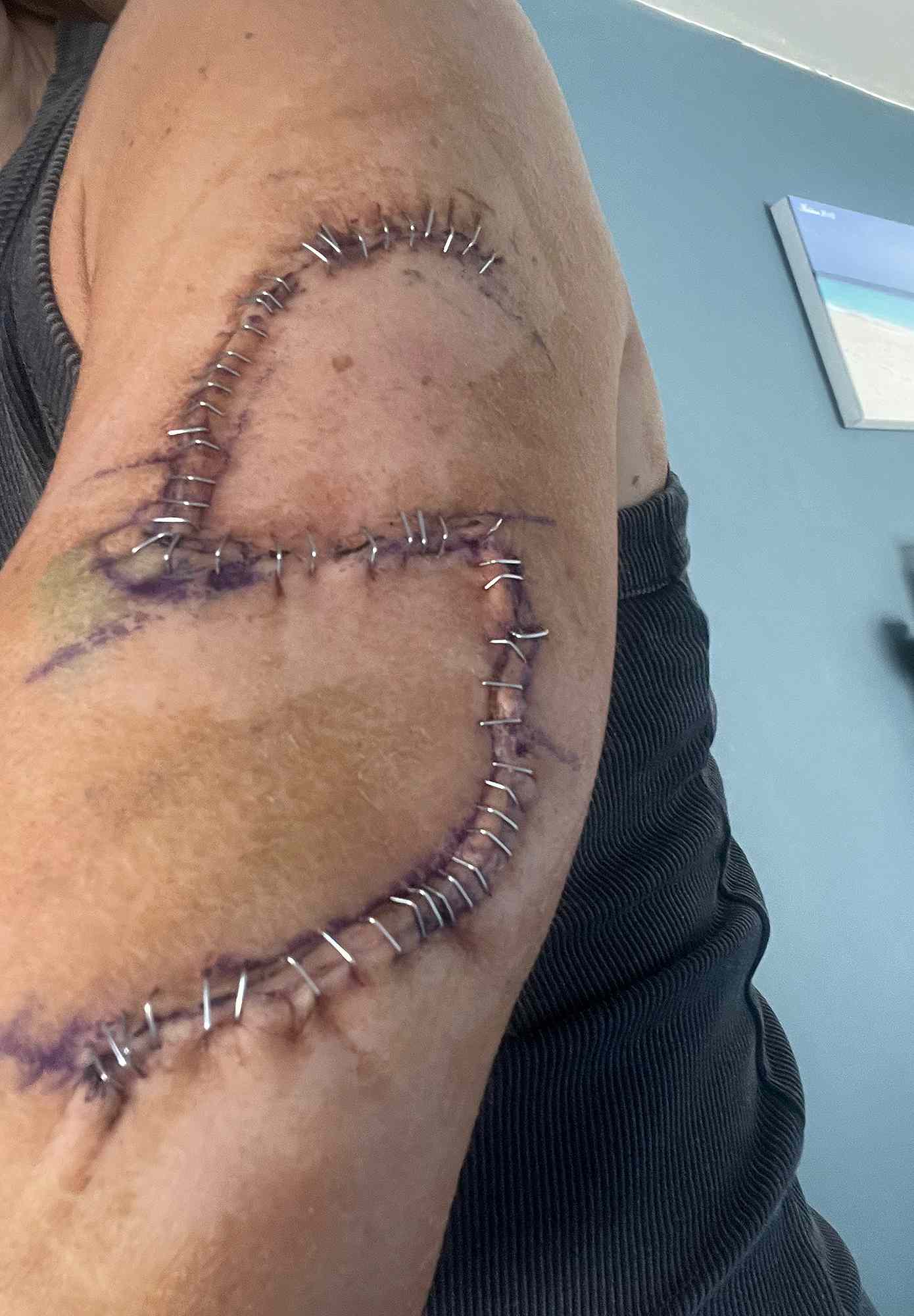 Mom Gets 77 Stitches in Arm After She Ignores a ‘Normal’ Mole - Everything