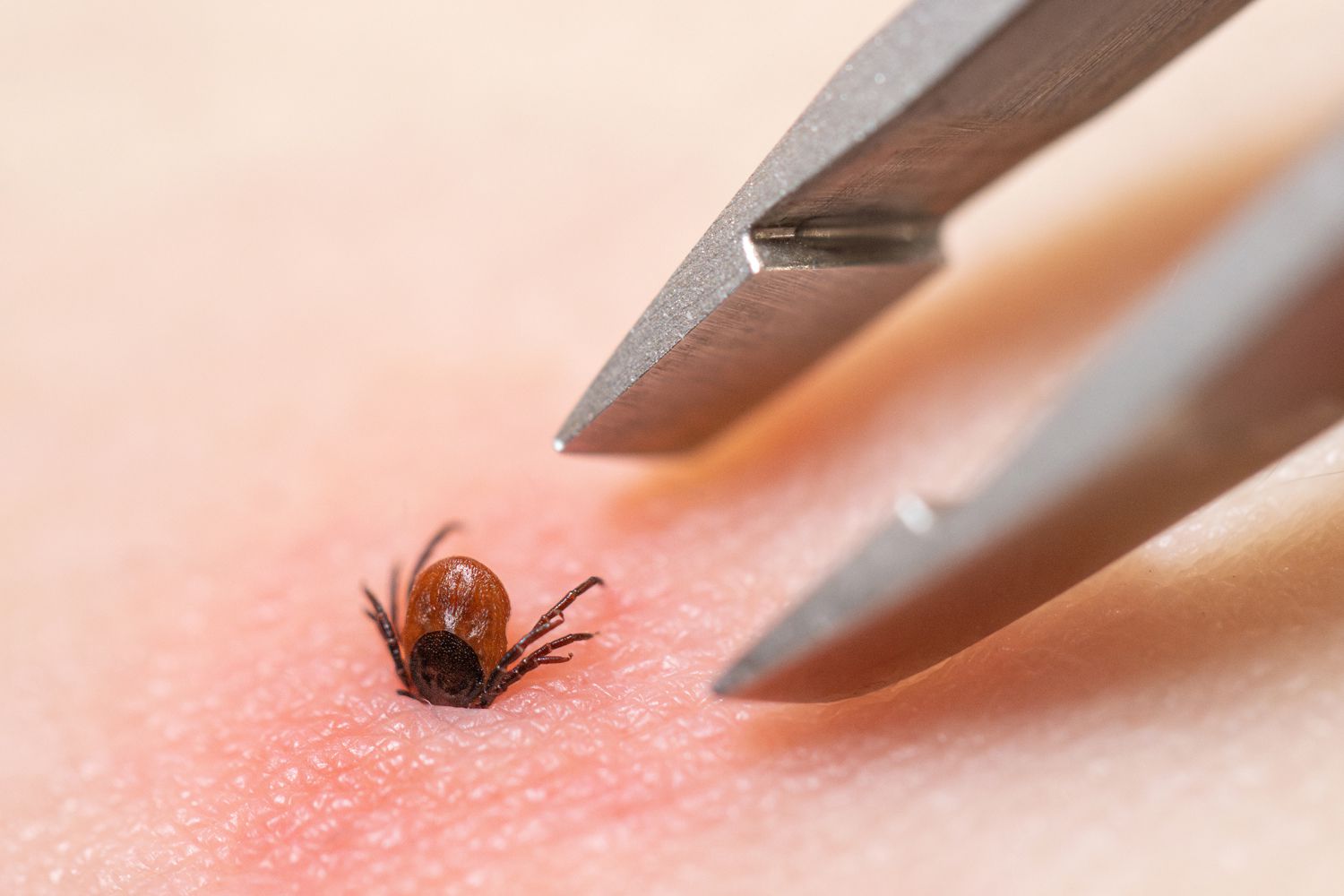 Man Died from Tick-Borne Virus After His ‘Brain Had Blown Up’. Now His ...