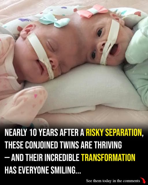 Conjoined twins Abby and Erin Delaney: Inside their remarkable story ...